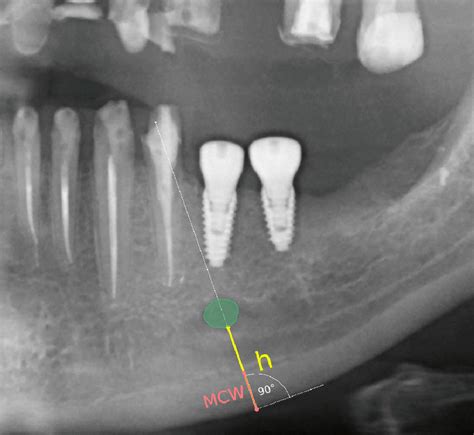 Figure 2 From Impact Of Bisphosphonate Therapy On Oral Health In Patients With Breast And