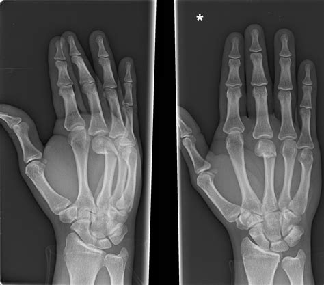 Metacarpal Neck Fracture