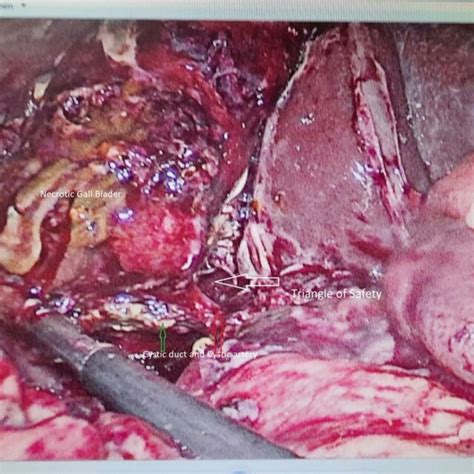 Ct Scan Showing Perforated Gallbladder Arrow Ct Computed Tomography Download Scientific Diagram