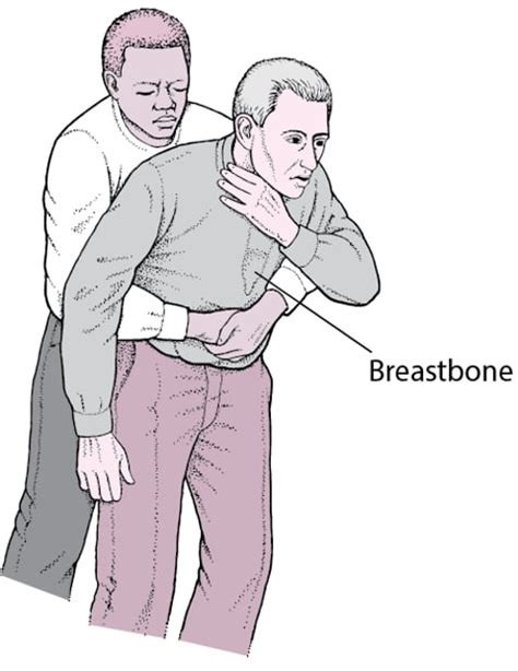 Imageperforming Abdominal Thrusts Heimlich Maneuver Msd Manual