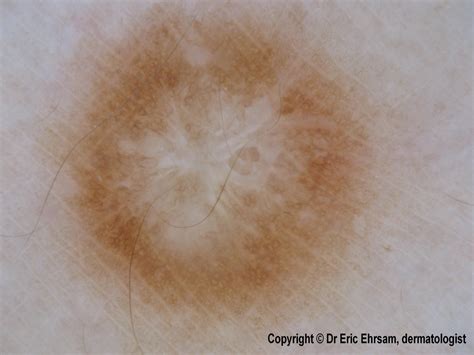 Dermoscopy Peripheral Reticular Pigmentation