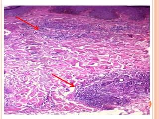 Cutaneous Metastasis Of Breast Cancer Pptx