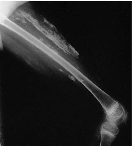 Skeletal And Extraskeletal Calcification And Ossification Syndromes Basicmedical Key