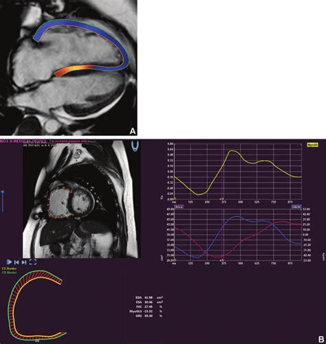 RV Strain Map A Four Chamber Cine SSFP Image Shows RV Strain