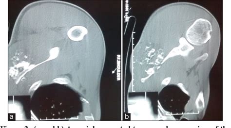 Figure 1 From Subtotal Scapulectomy In A Patient With Chondroma Scapula A Case Report