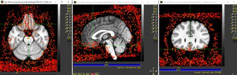 3d Icc A Lot Of Outside Brain Sig Voxels Afni Message Board Afni Discuss Message Board