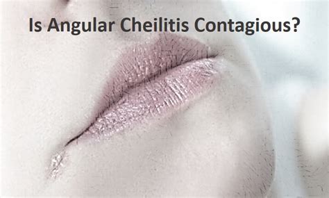 Angular Cheilitis Contagious Angular Cheilitis Facts