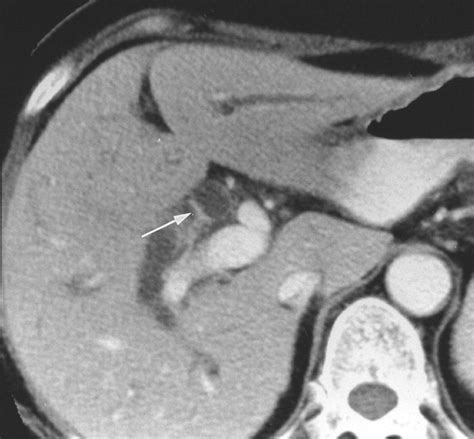 Cholangiocarcinoma Morphologic Classification According To Growth