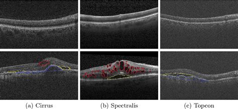 Figure 1 From Retinal Fluid Segmentation And Detection In Optical