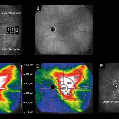 Wide Field Retinal And Choroidal Thickness Maps Before And After
