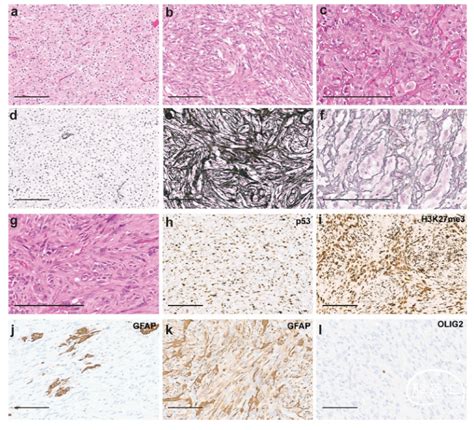 少突胶质肉瘤：一类特殊的胶质瘤 脑医汇