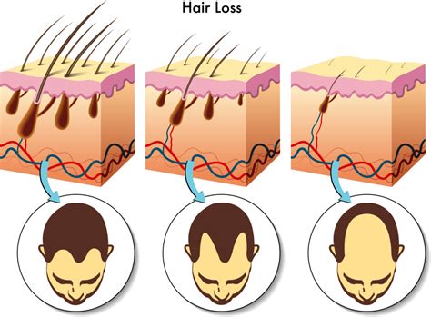 Hair Loss In Men Mumbles Clinic