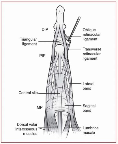 Extensor Tendon Repair Musculoskeletal Key