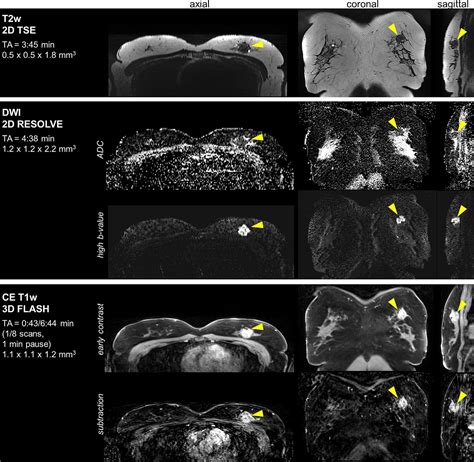 Supine Breast Mri Using A Wearable Coil Facilitates The Translation Of