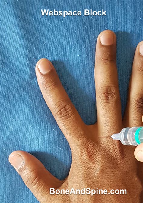 Digital Nerve Block Indications Techniques And Safety Tips Bone And Spine