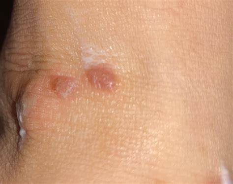 Is This Scabies Please Help Id R Scabies