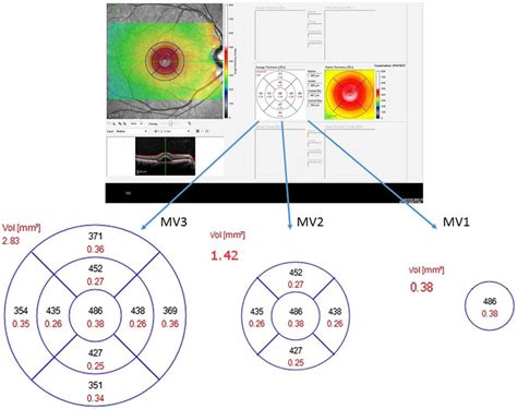 Macular Volume Measurement Macular Volume Within 1 Mm Diameter Mv 1 Download Scientific