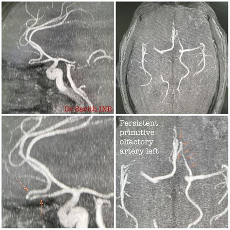 Savith Kumar On Linkedin Persistent Primitive Olfactory Artery