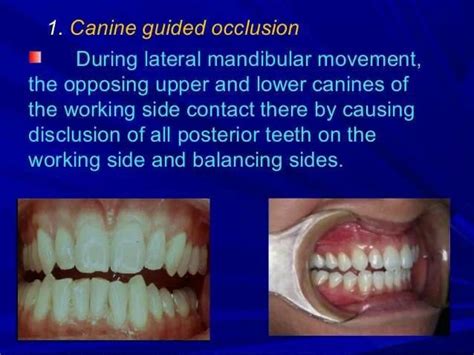 5th L Mutually Protected Occlusion Pptx