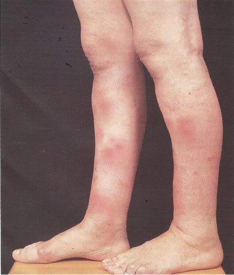 Eritema Nodoso Causas Sintomas E Exames Laboratoriais