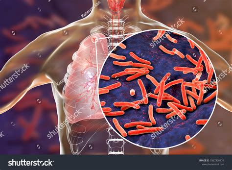 Mycobacterium Tuberculosis Lungs