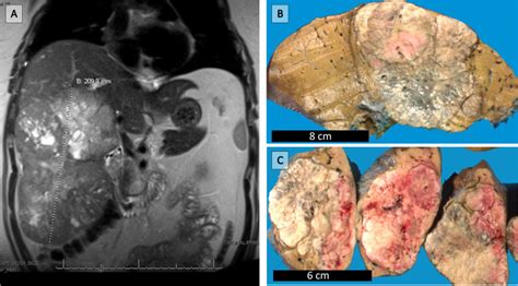 Pediatric Combined Hepatocellular Cholangiocarcinoma Chcc Cc With Neuroendocrine Features