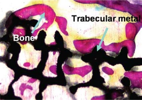 Fixation By Ingrowth Musculoskeletal Key