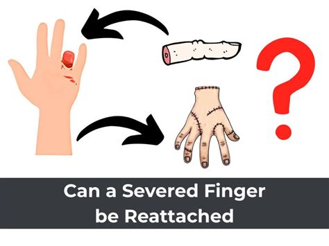 Crouch Gait In Cerebral Palsy Symptoms And Treatment Options