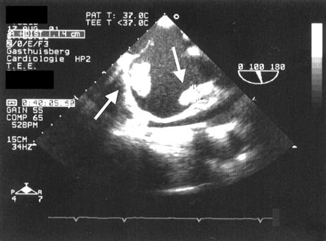 Transoesophageal Echocardiogram Of A Patient 10 Years After A Fontan Download Scientific