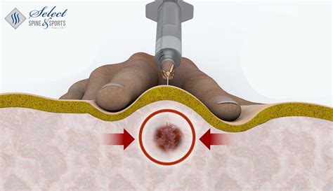 Trigger Point Injections Friendswood TX