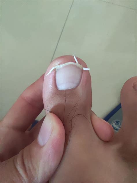 脚趾甲想正往肉里长该怎么办——甲沟炎简易预防 知乎