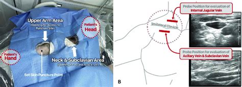 Procedure Site Of The PICC Insertion At The Bedside Under Ultrasound Download Scientific