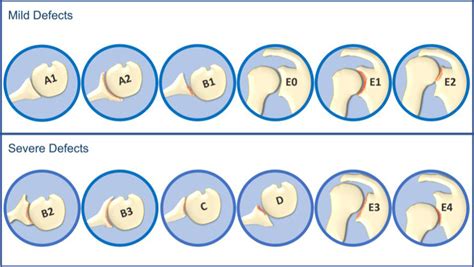 Navigation Increases The Accuracy Of Glenoid Component Implantation In