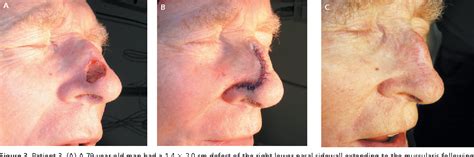 Figure 1 From Introduction To Flap Movement Reconstruction Of Five Similar Nasal Defects Using