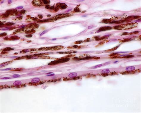 Choroid 1 By Jose Calvo Science Photo Library