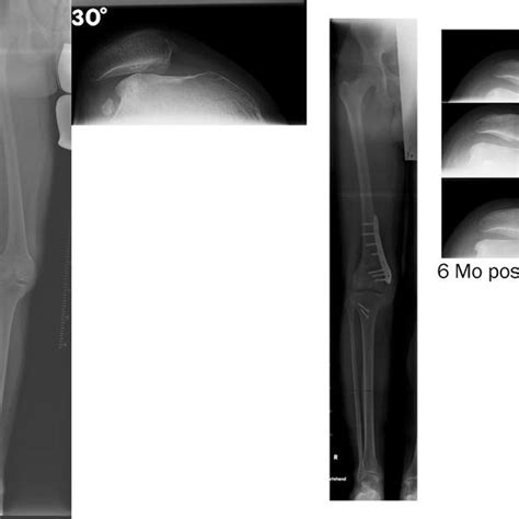 Classification Of Patella Instability And Maltracking The Grading Is