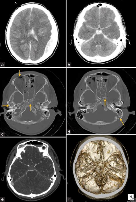 Surgical Neurology International
