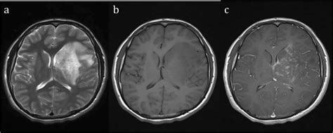 Initial Mri Of The Brain Axial T2 Weighted A Axial T1 Weighted B