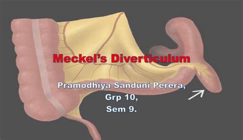 Meckels Diverticulum Pptx