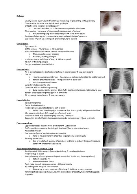 Chest X Ray Consolidation Vs Infiltrate