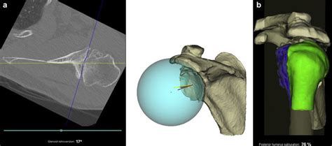 A Glenoid Retroversion The Version Angle Is Automatically Computed