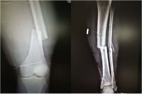 Ipsilateral Femoral And Tibial Shaft Fracture Of The Left Limb F