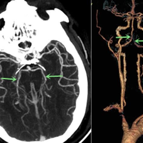 A Patent Bilateral Vertebral Arteries Arrow On Cta Neck From Three