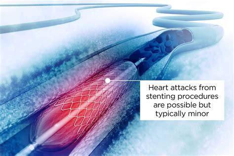 What Are The Risks Of Getting A Stent Qnhv