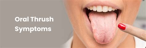 Oral Thrush In Adults And Infants Symptoms Causes Treatment