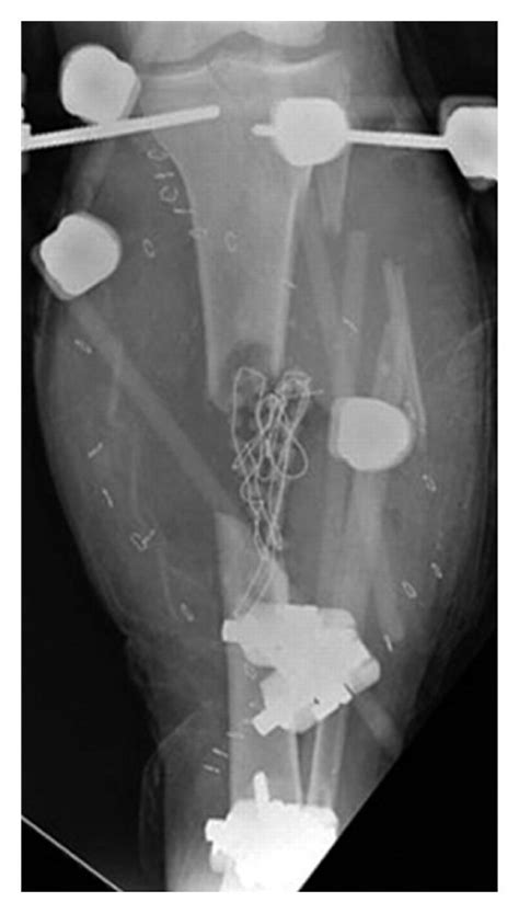 A Radiograph Of Open Tibial Fracture With Segmental Bone Loss As A Download Scientific