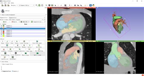 Segment Editor模块中split Volume分割方法 2，来自 304808813 经验分享 3dslicer中文论坛