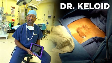 Dr Keloid Chest Keloid Removal Youtube