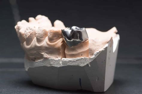 All About Metal Dental Crowns Online Dental Care