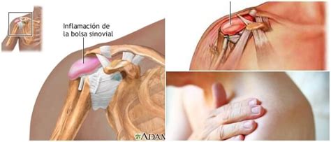 Bursitis De Hombro Causas Síntomas Diagnóstico Y Tratamiento Arriba Salud